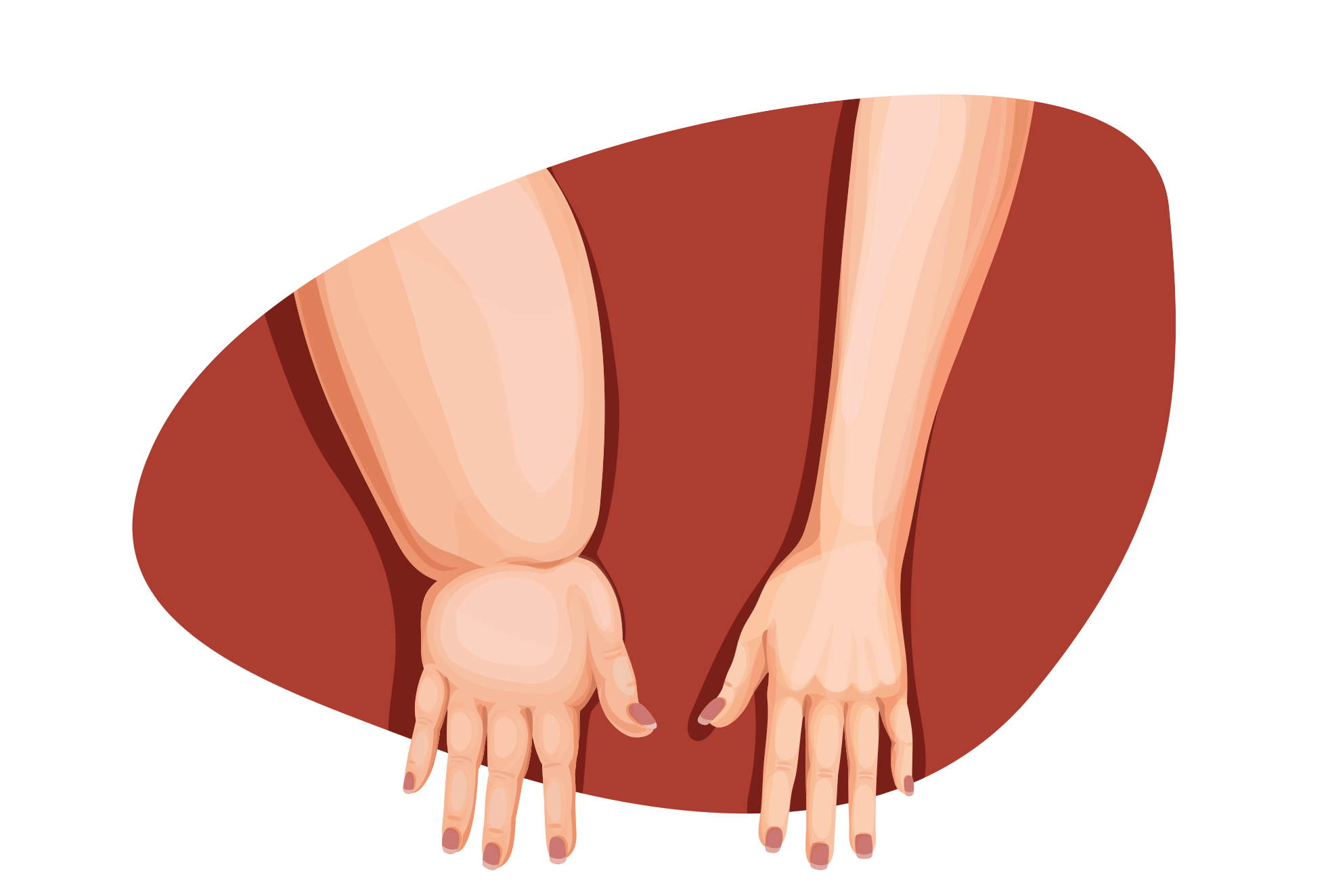 Understanding Edema: Addressing Swelling in the Body' - Insights into ...